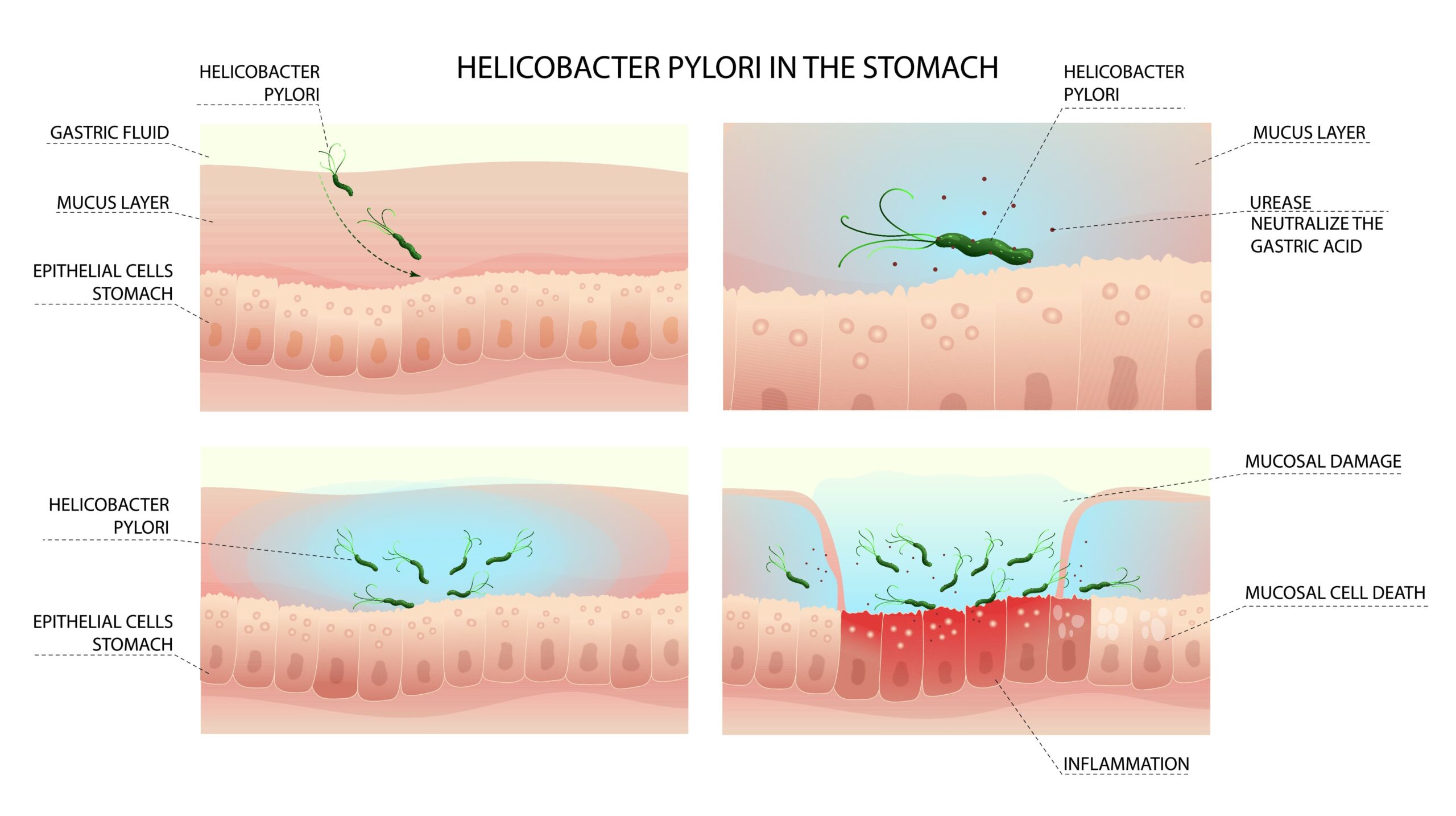 Helicobacter pylori Infection | Pharmacology Mentor