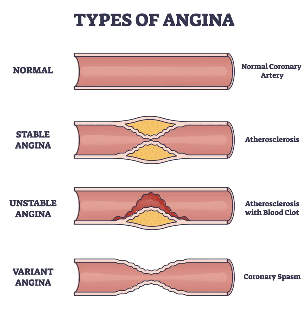 Angina Pectoris: A Comprehensive Guide | Pharmacology Mentor